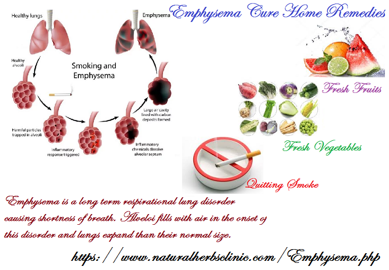 Natural Remedies for Emphysema an Excellent Solution to Treat it