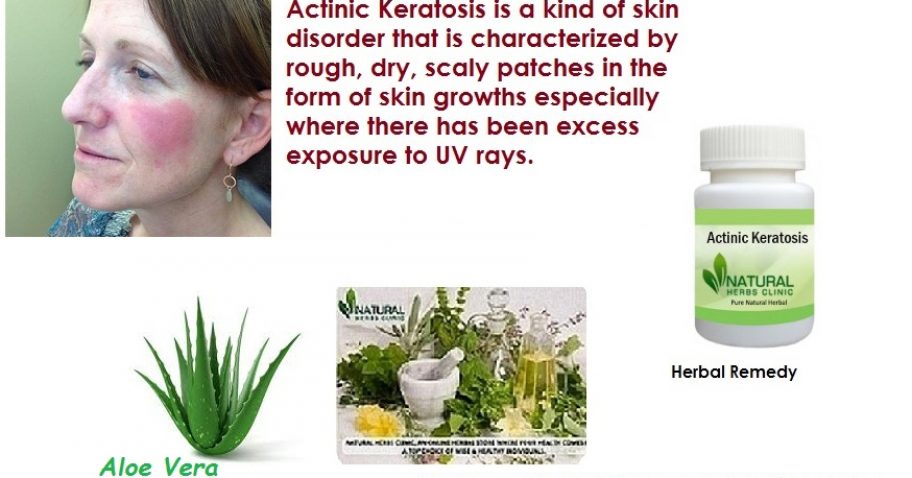 Actinic Keratosis Dermnet Archives Natural Herbs Clinic Blog