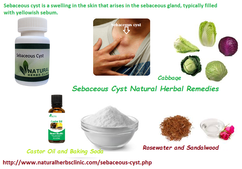 Herbal Remedies For Sebaceous Cyst Causes Symptoms Treatment