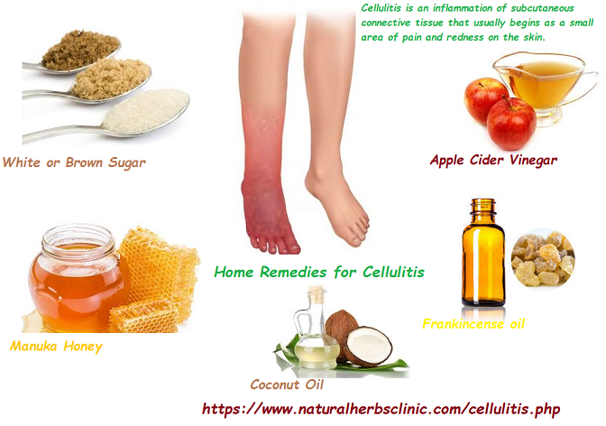 5 Natural Herbal Remedies for Cellulitis - Natural Herbs Clinic Blog