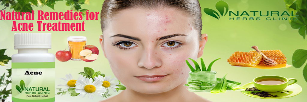 Natural Remedies for Acne Complete Natural Treatment