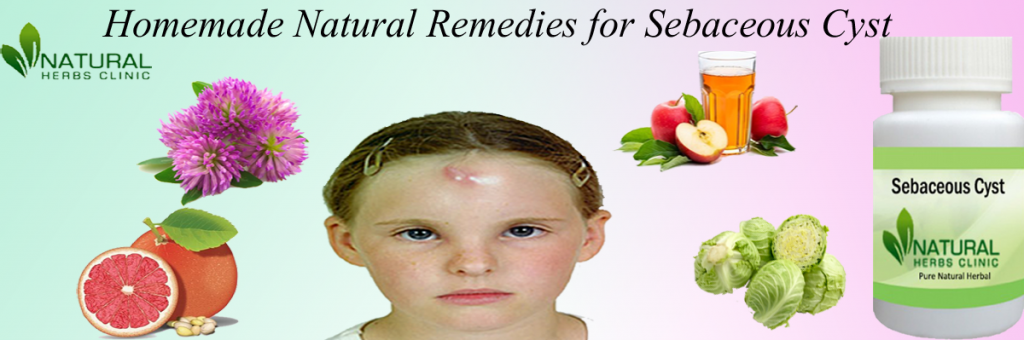 Homemade Natural Remedies for Sebaceous Cyst