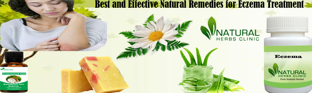 Natural Remedies for Eczema to Get rid of it Quick