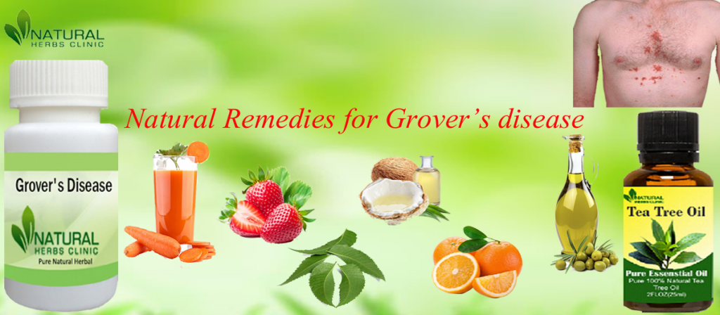 Make Use of Natural Remedies for Grover’s Disease Recovery