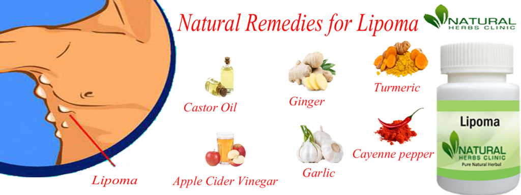 How to Treat Lipoma Completely with Natural Remedies