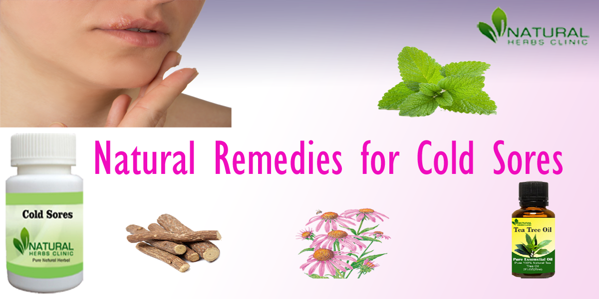 Cold Sores Natural Remedies and Treatment Strategies