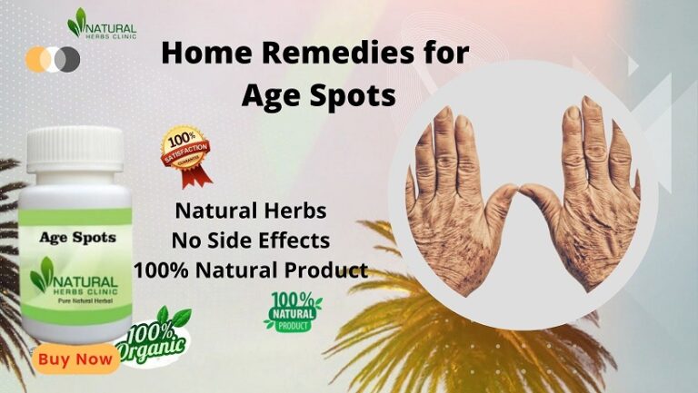 10 Natural Herbal Remedies for Age Spots - Natural Herbs Clinic Blog