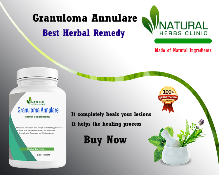 Home Remedies for Subcutaneous Granuloma Annulare Treatment Natural