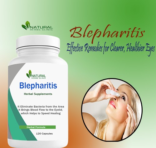 Blepharitis Natural Remedies: A Holistic Approach to Eye Health