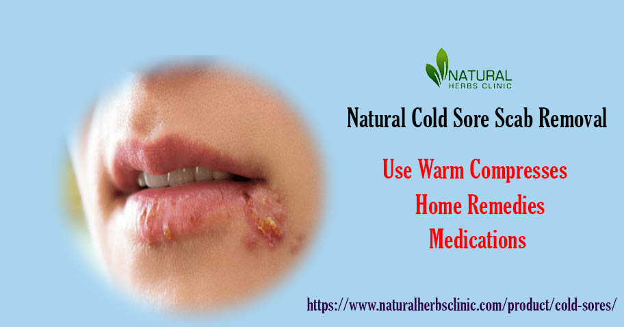 Natural Cold Sore Scab Removal Best Ways to Manage the Blisters