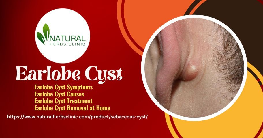 Treating Sebaceous Cyst On Scalp Archives Natural Herbs Clinic Blog