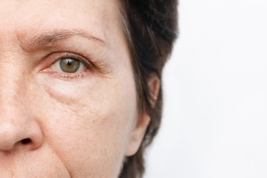How to get rid of eye bags, according to dermatologists - Natural Herbs ...