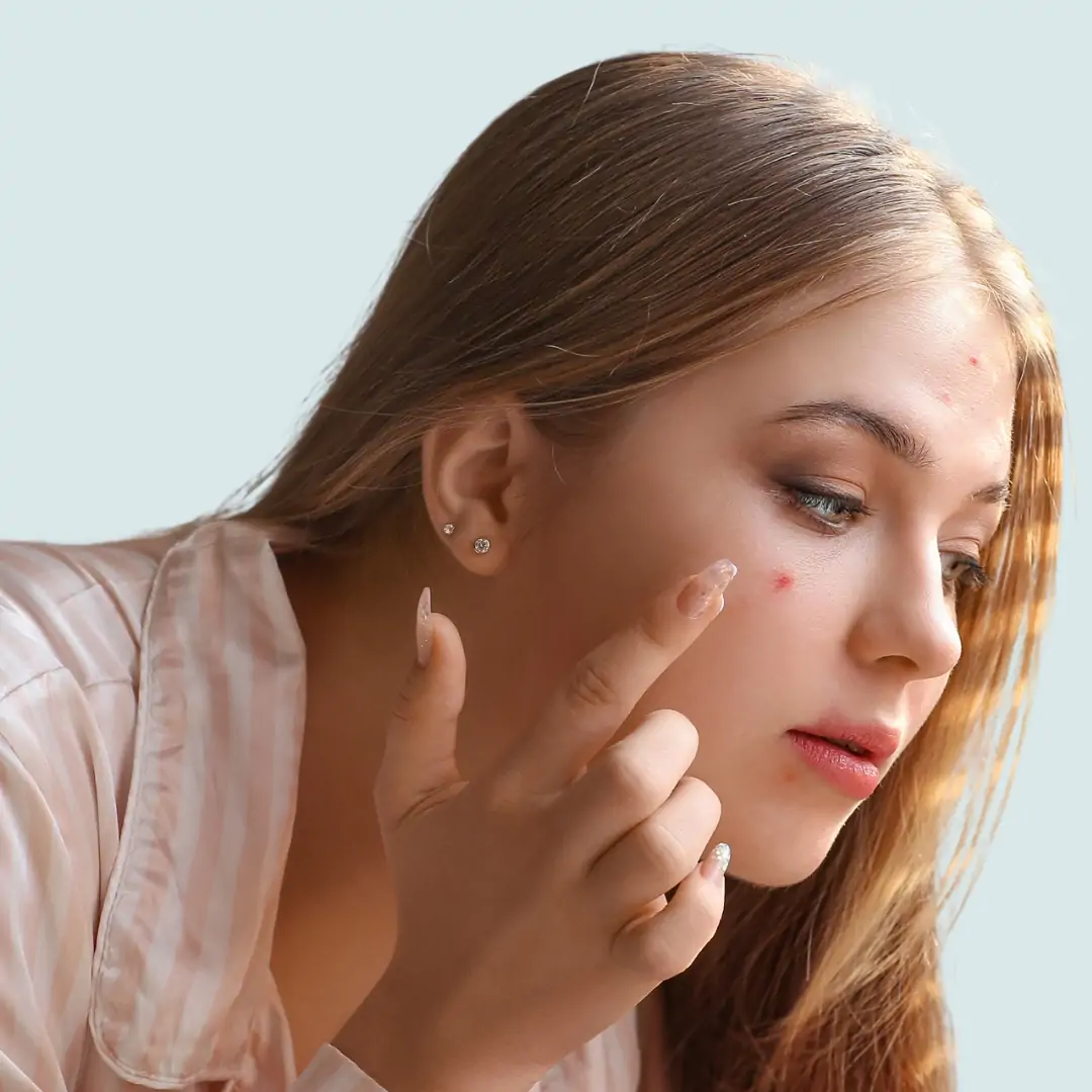 Sebaceous Cyst Treatment At Home Your Complete Diy Guide Natural
