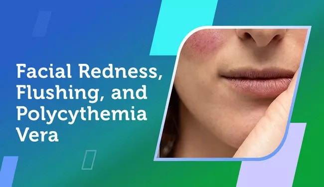 Exploring Polycythemia Vera Alternative Treatments: Natural Approaches ...